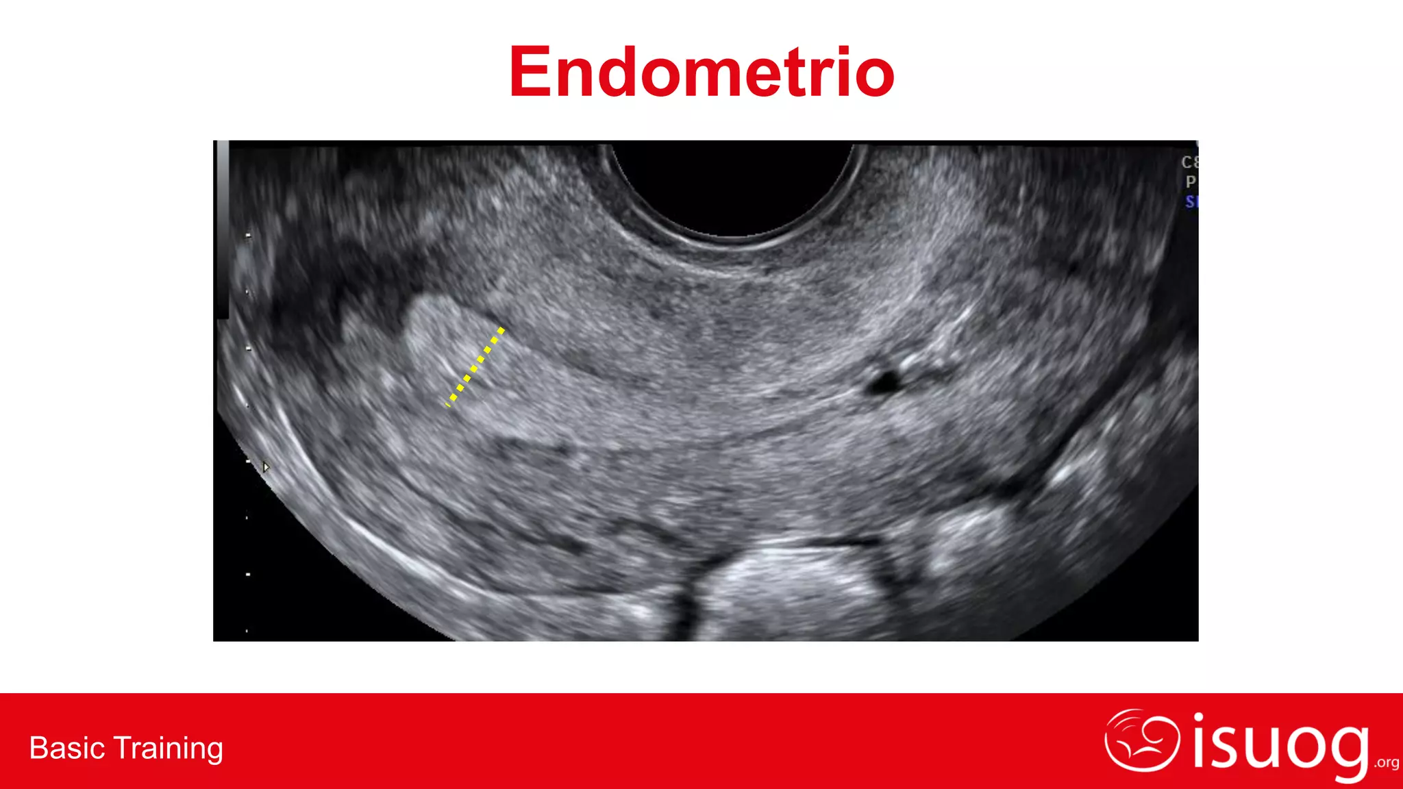 GUIA DE ECOGRAFIA DE utero-cuello-y-endometrio-rev-CV-1019.pdf