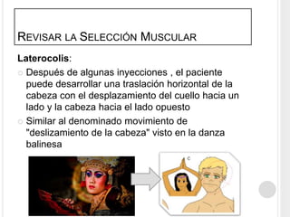 Distonia Cervical | PPT