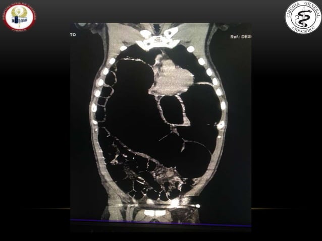 Guia de hipertension intraabdominal y el sindrome compartimentale ...