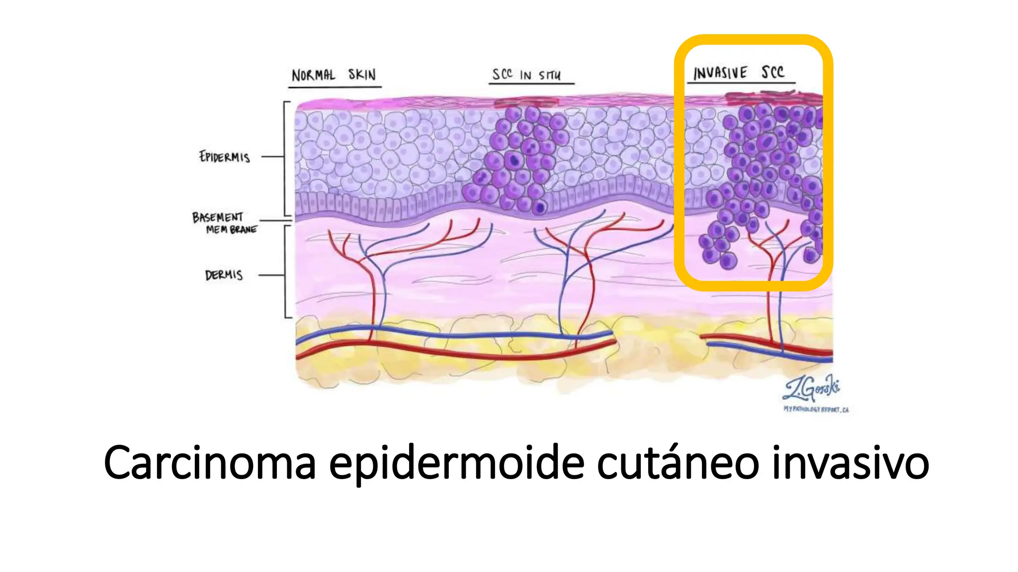 Guias Carcinoma epidermoide cutaneo.pptx