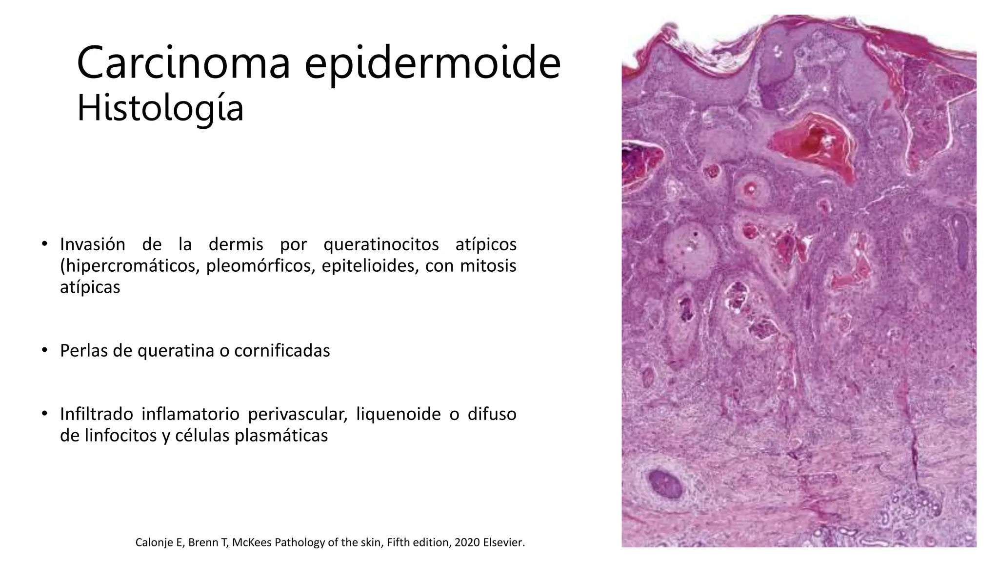 Guias Carcinoma epidermoide cutaneo.pptx