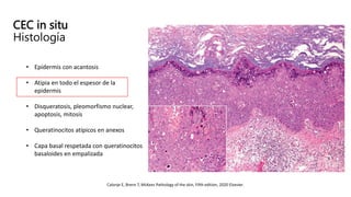 Guias Carcinoma epidermoide cutaneo.pptx