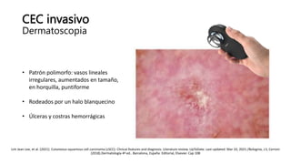 Guias Carcinoma epidermoide cutaneo.pptx