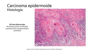 Guias Carcinoma epidermoide cutaneo.pptx