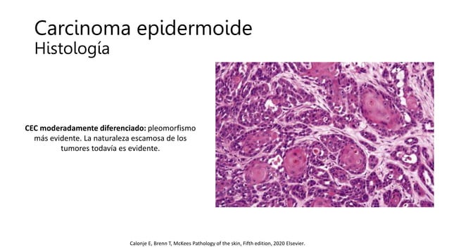 Guias Carcinoma epidermoide cutaneo.pptx