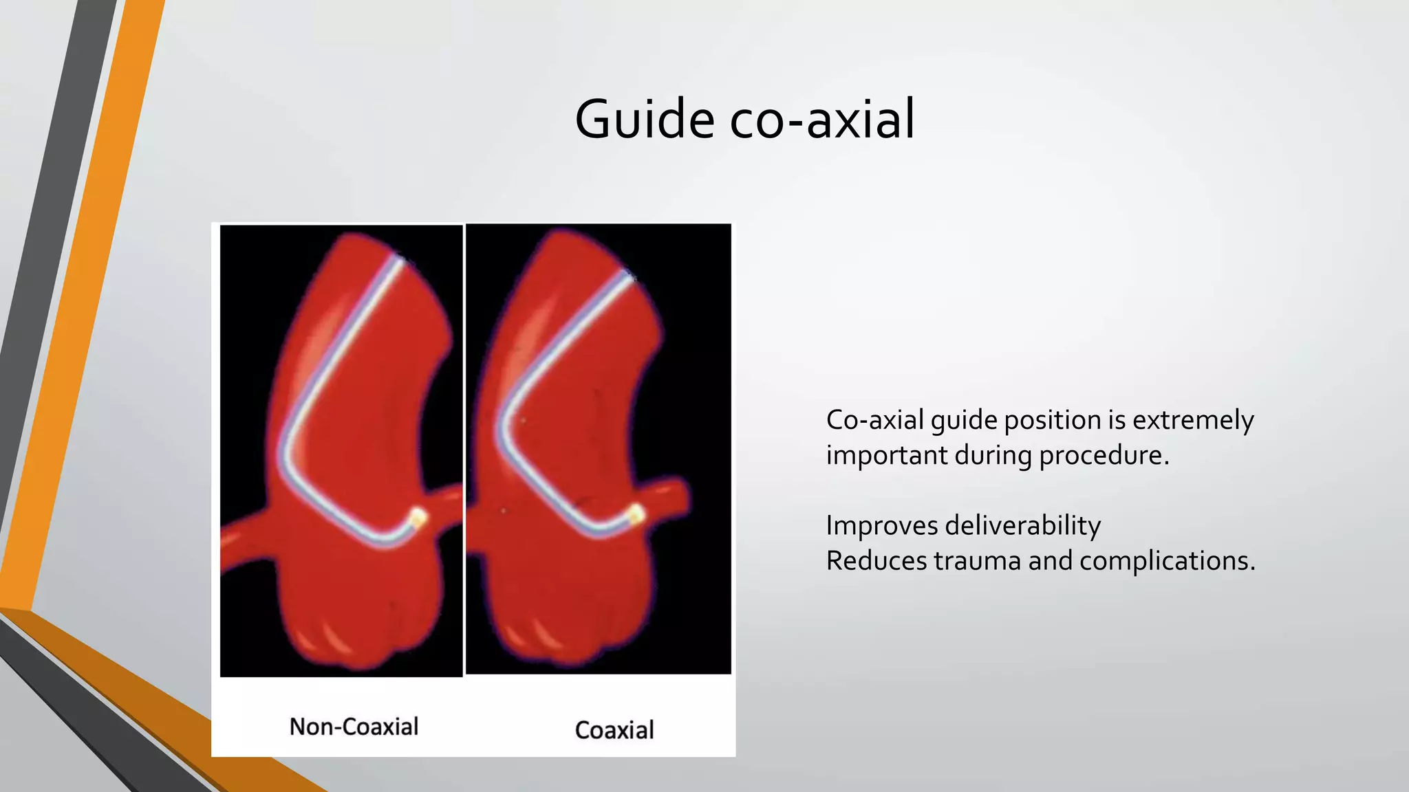 Guide catheters in coronary intervention | PPTX