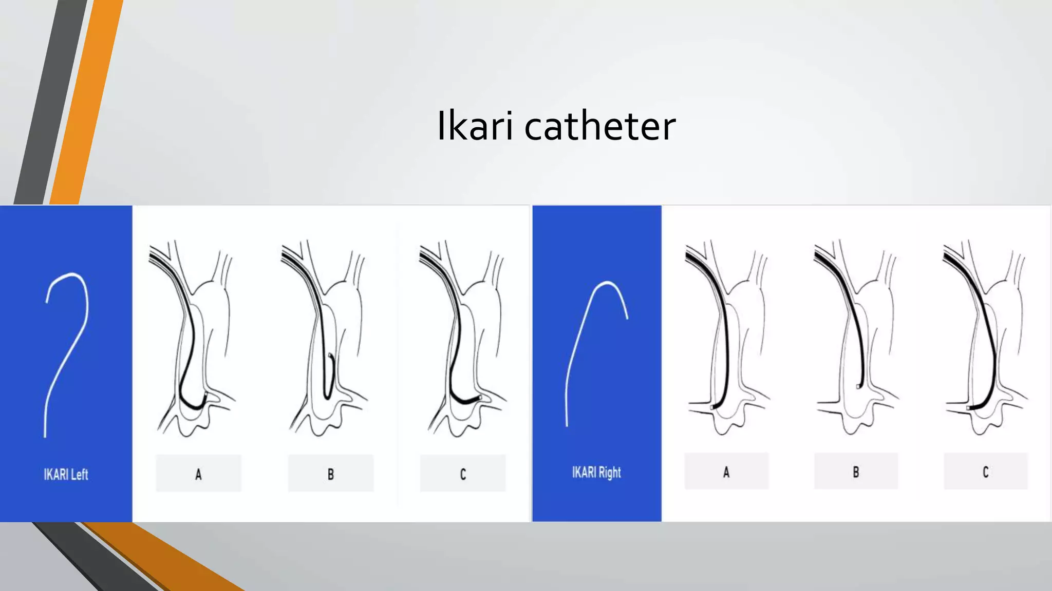 Guide catheters in coronary intervention | PPTX