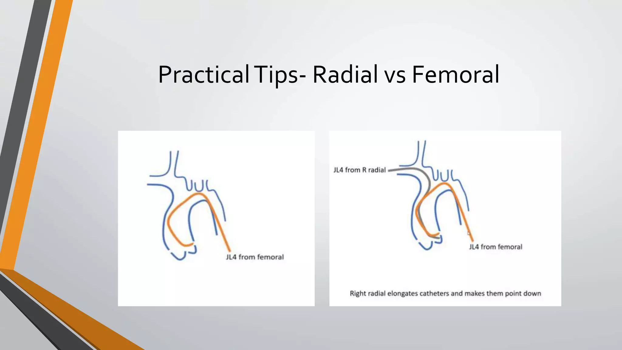 Guide catheters in coronary intervention | PPTX