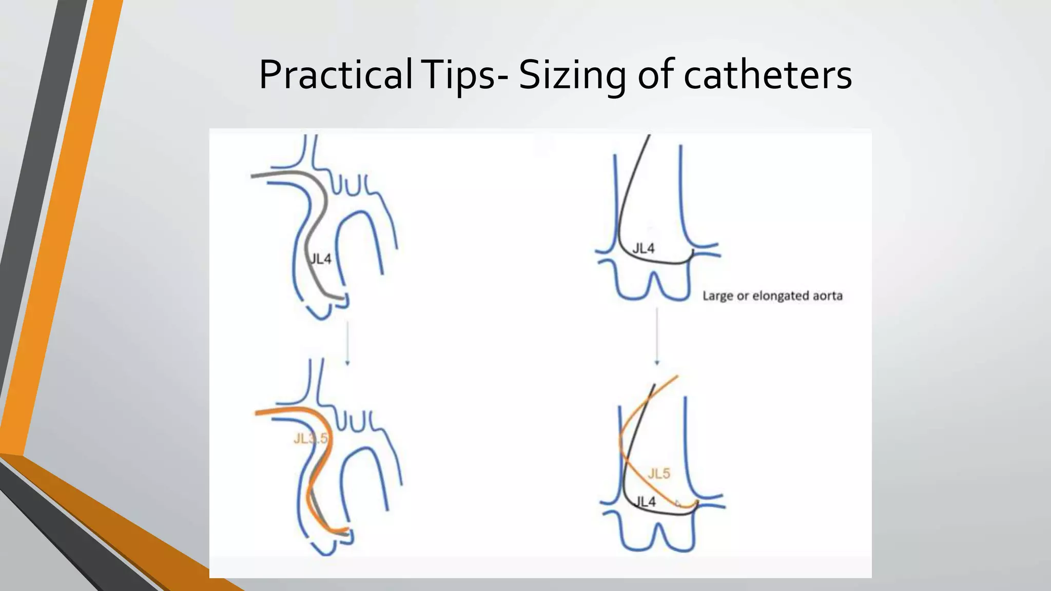 Guide catheters in coronary intervention | PPTX