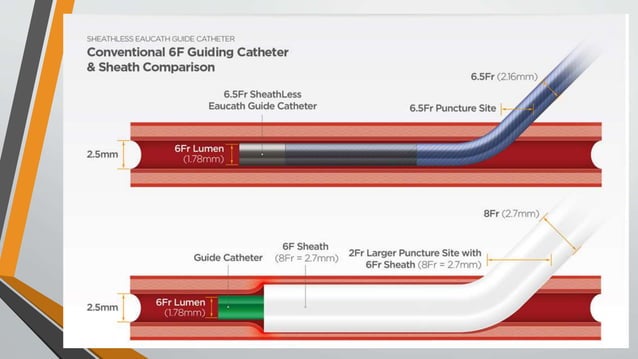 Guide catheters in coronary intervention | PPTX