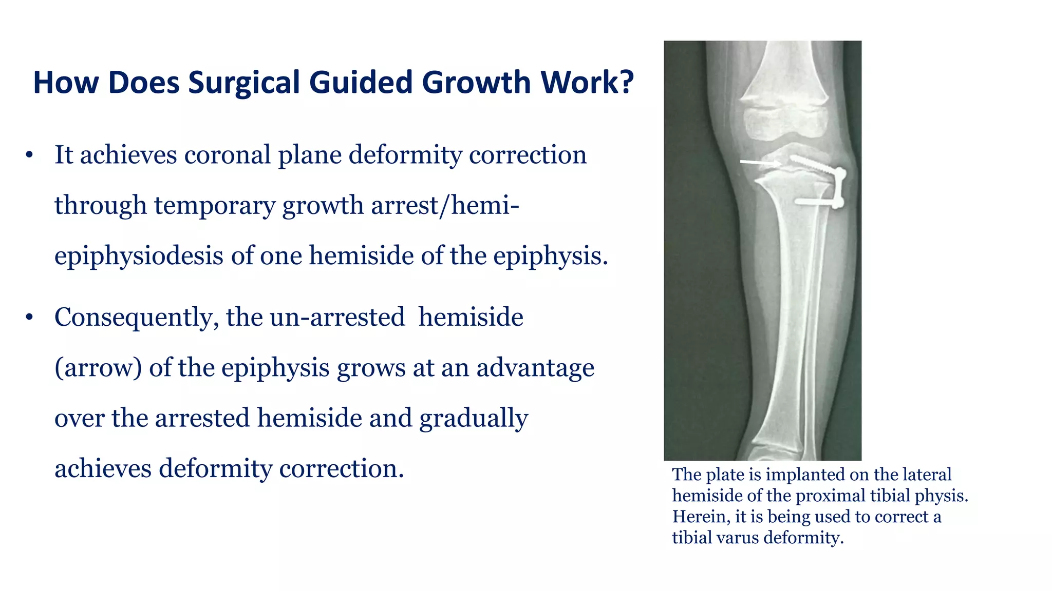 Guided Growth for Angular Knee Deformities in Nutritional Rickets ...