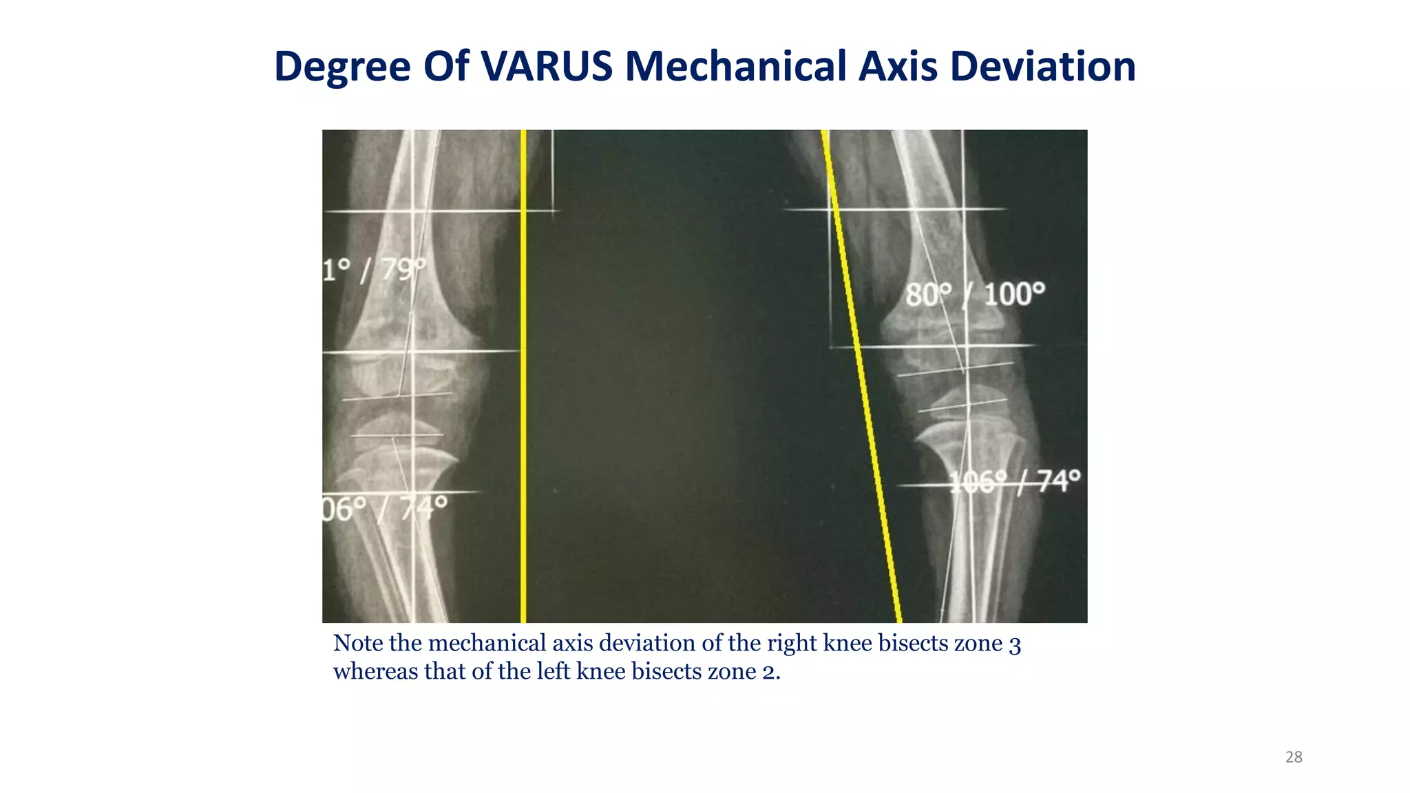 Guided Growth for Angular Knee Deformities in Nutritional Rickets ...