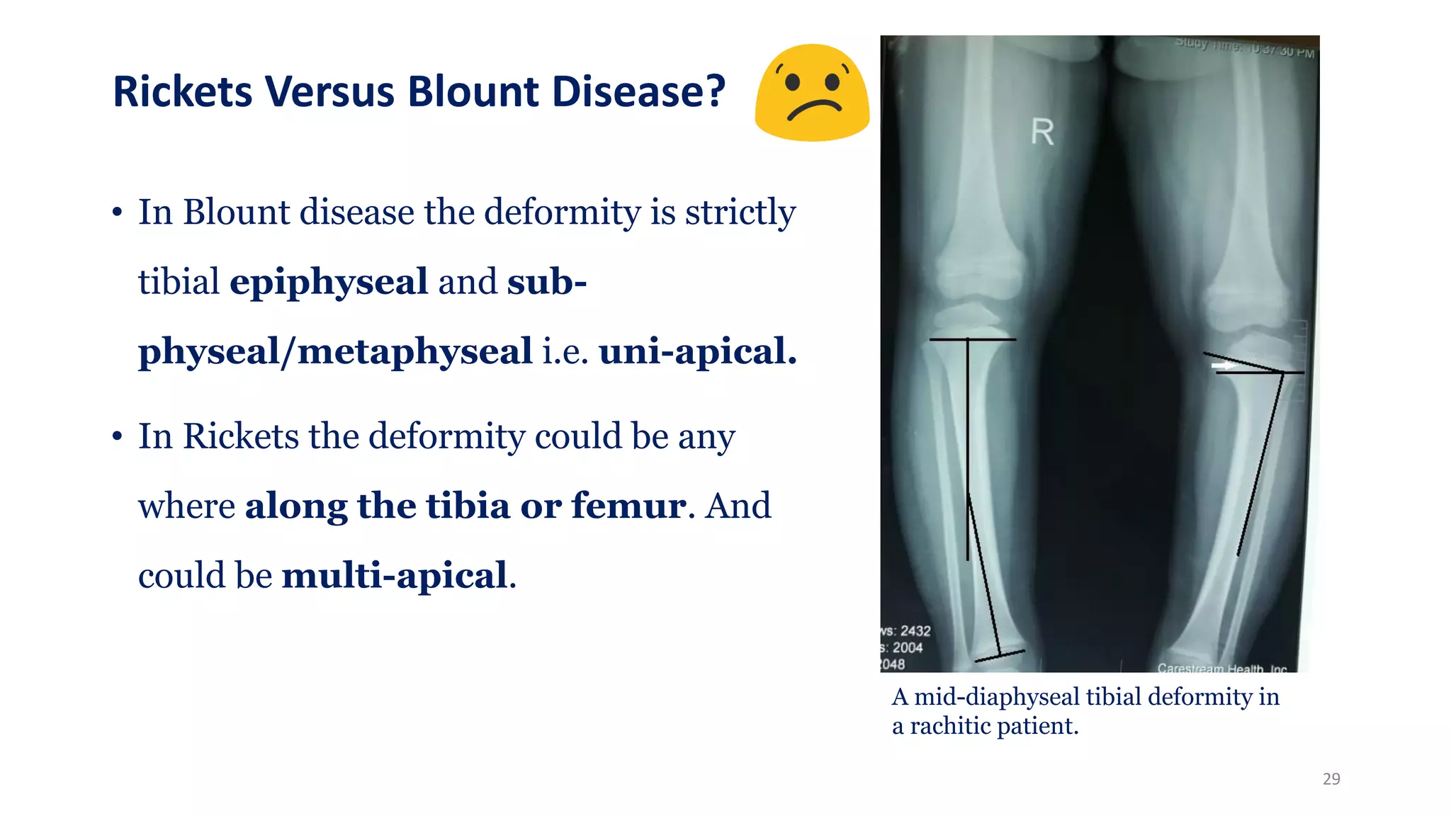 Guided Growth for Angular Knee Deformities in Nutritional Rickets ...