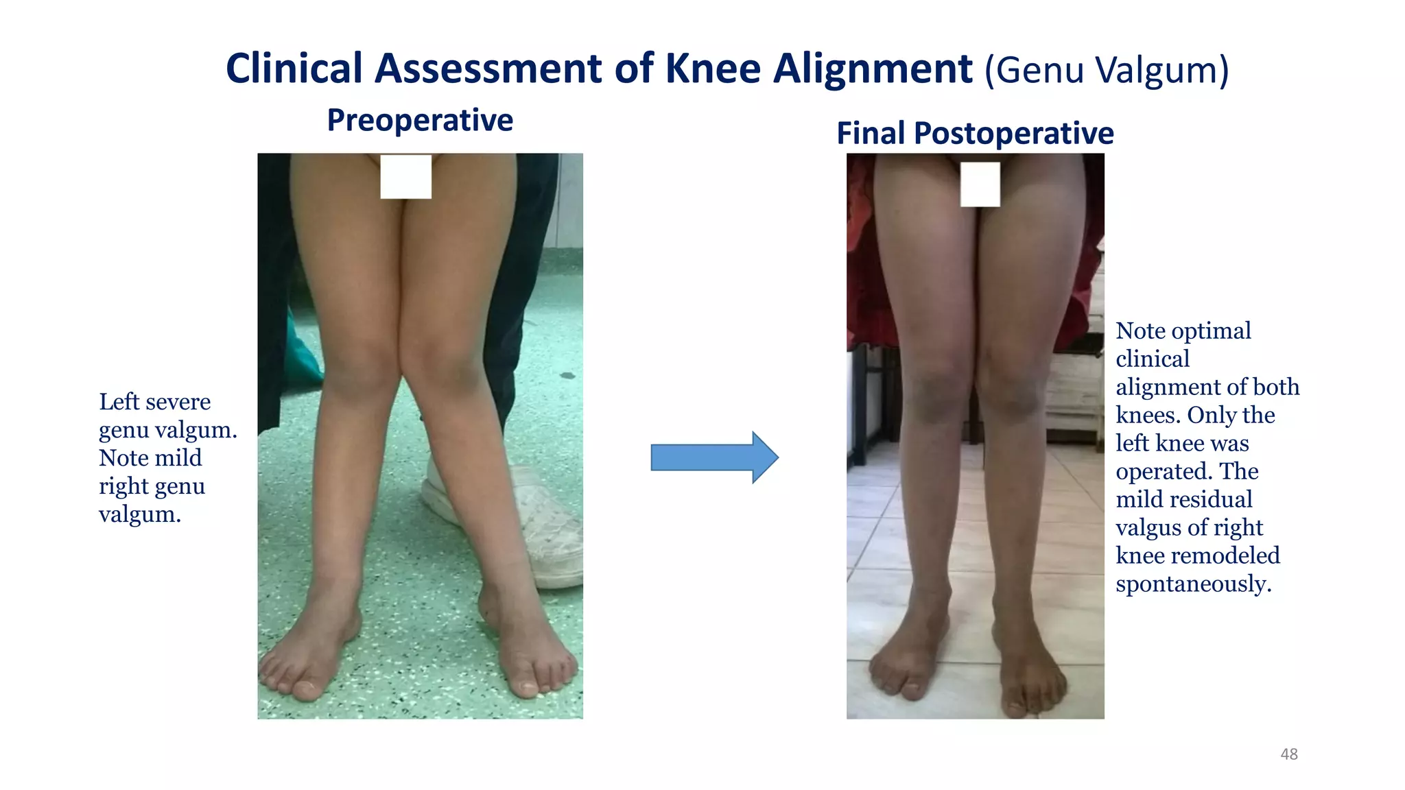 Guided Growth for Angular Knee Deformities in Nutritional Rickets ...