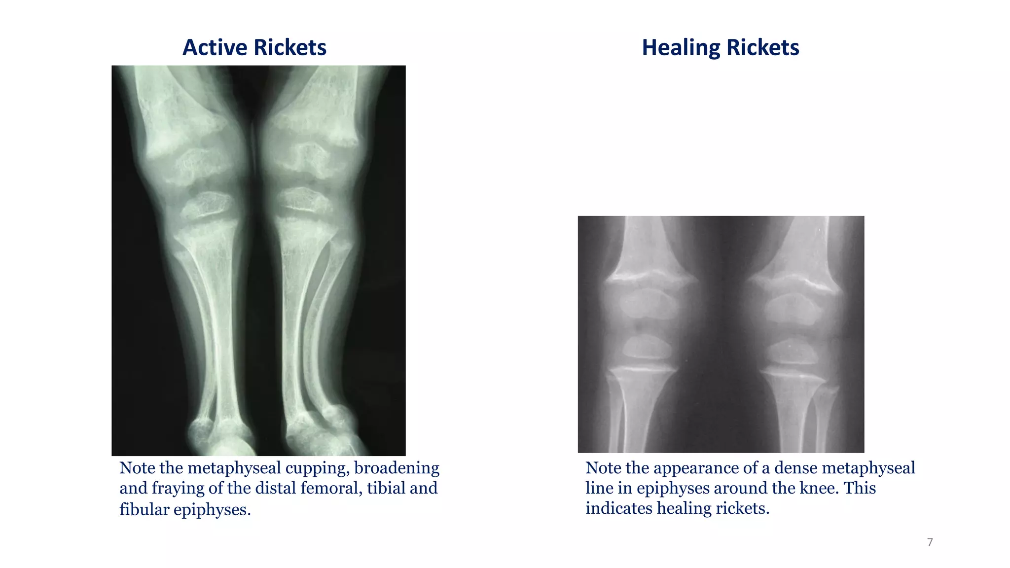 Guided Growth for Angular Knee Deformities in Nutritional Rickets ...
