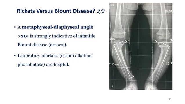 Guided Growth for Angular Knee Deformities in Nutritional Rickets ...