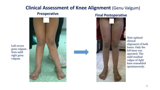 Guided Growth for Angular Knee Deformities in Nutritional Rickets ...