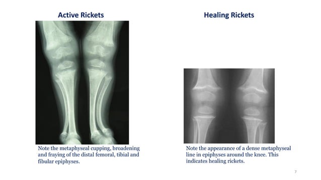 Guided Growth for Angular Knee Deformities in Nutritional Rickets Children | PPT
