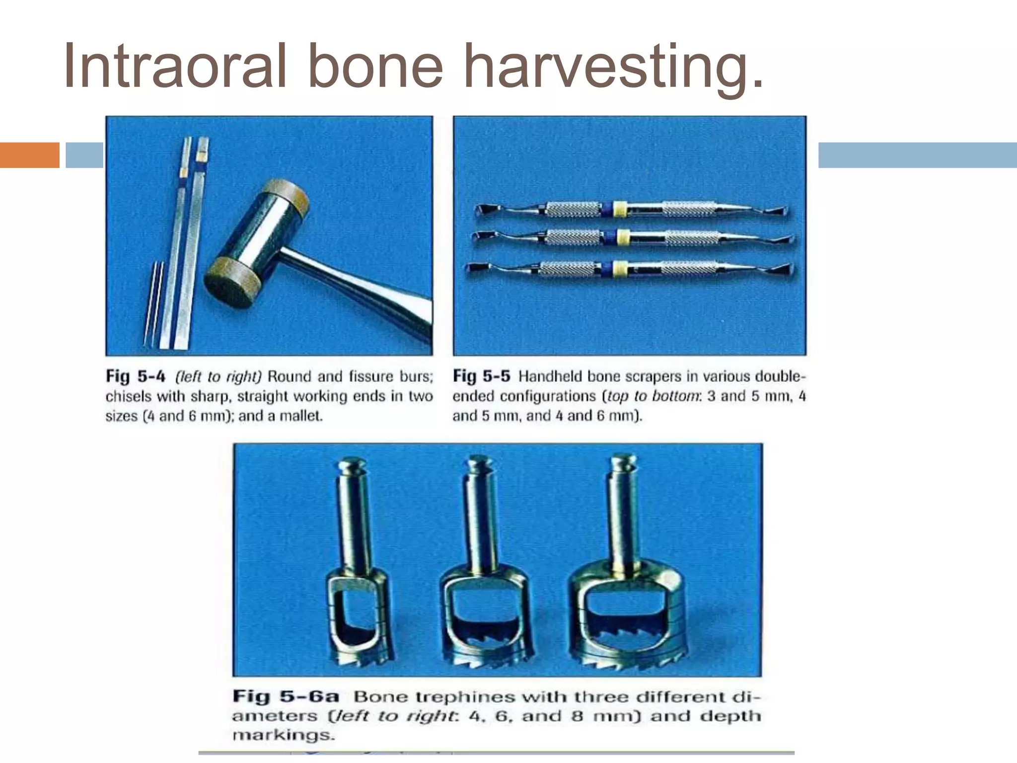Guided bone regeneration | PPTX