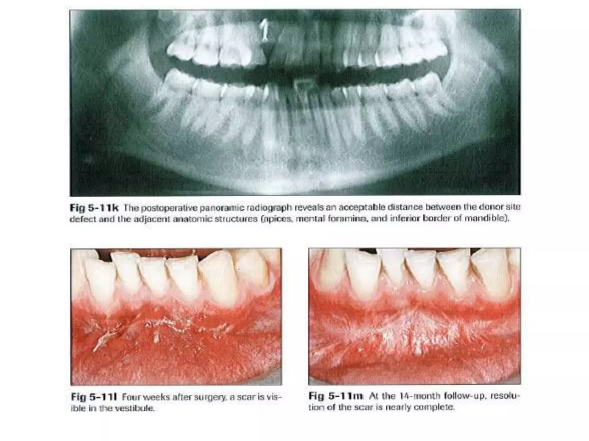Guided bone regeneration | PPTX