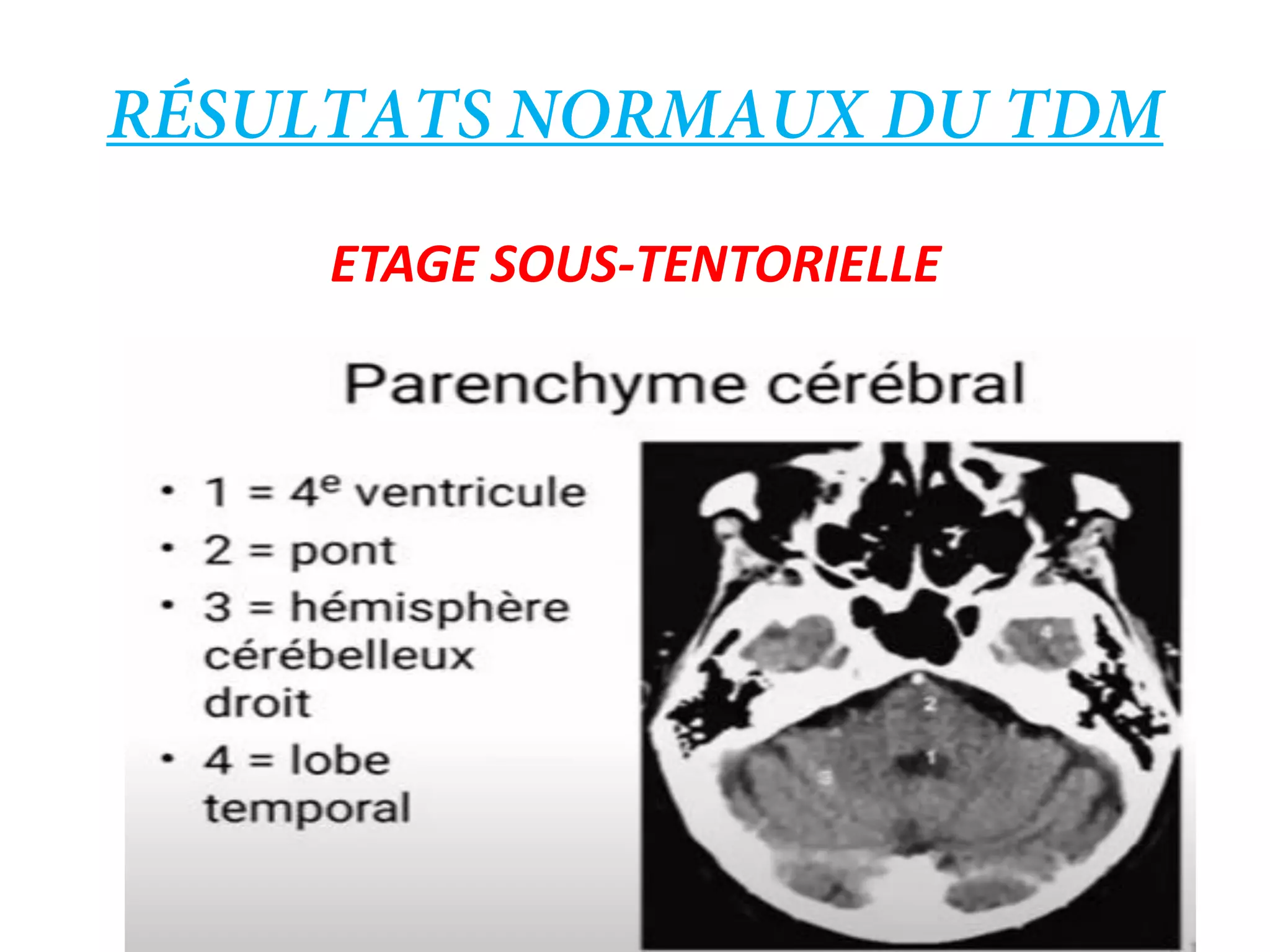 GUIDE D'INTERPRETATION D'UN TDM CEREBRALE EN URGENCE.pdf