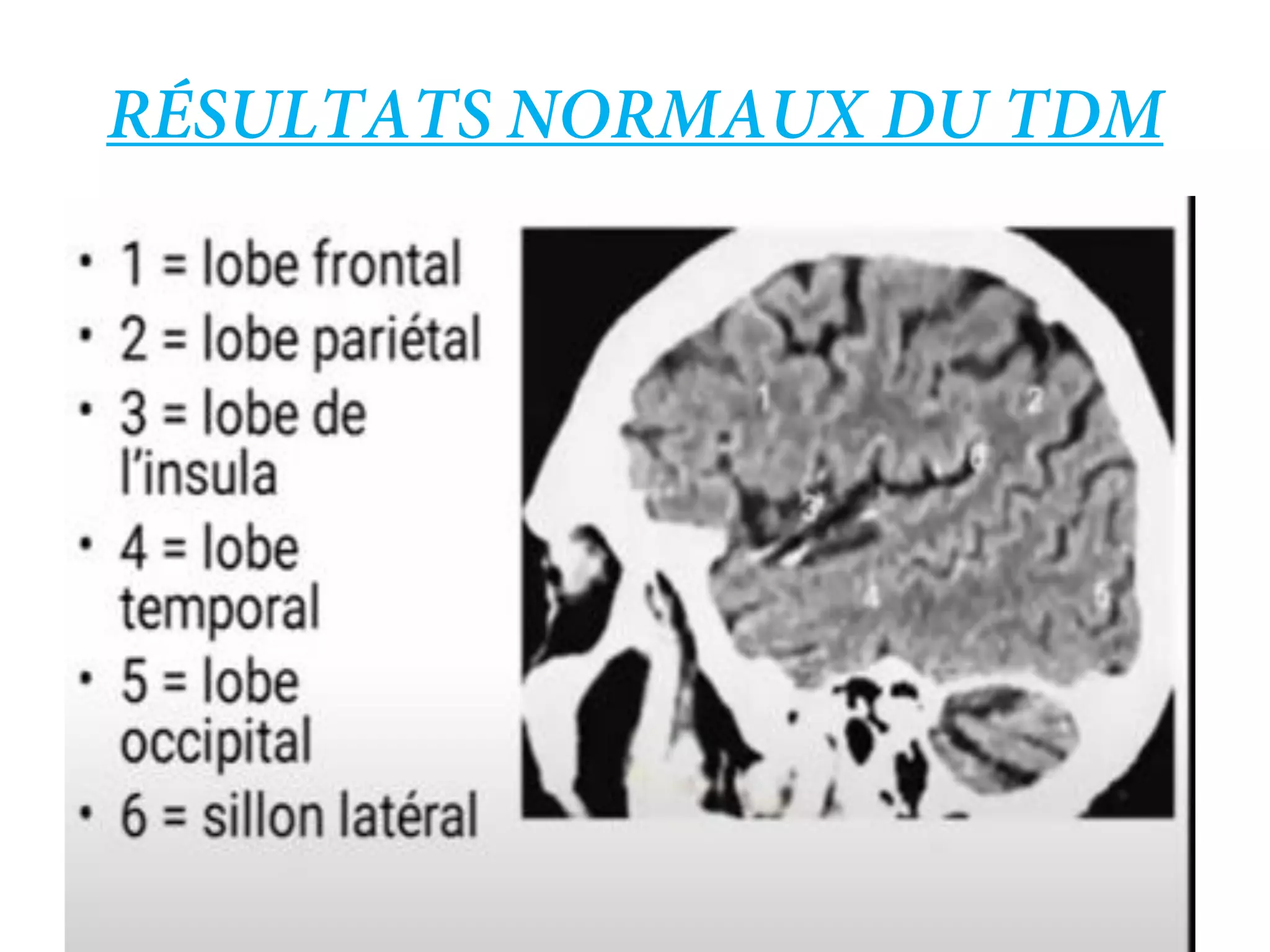 GUIDE D'INTERPRETATION D'UN TDM CEREBRALE EN URGENCE.pdf