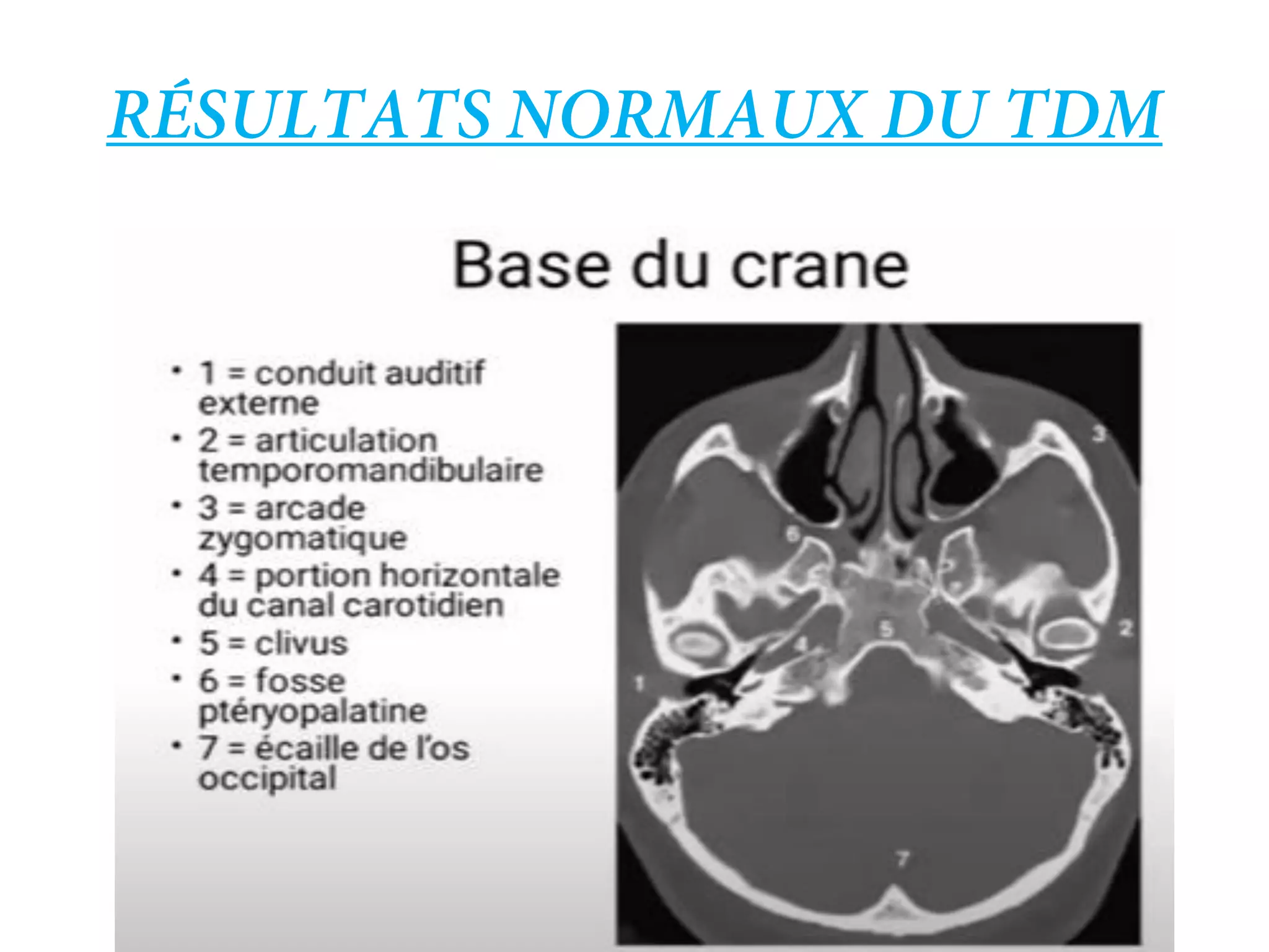 GUIDE D'INTERPRETATION D'UN TDM CEREBRALE EN URGENCE.pdf