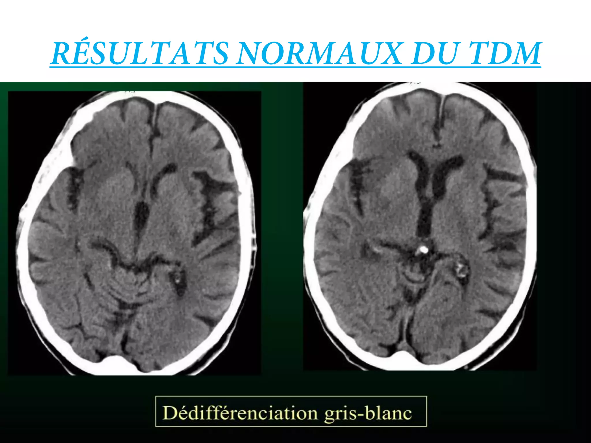 GUIDE D'INTERPRETATION D'UN TDM CEREBRALE EN URGENCE.pdf