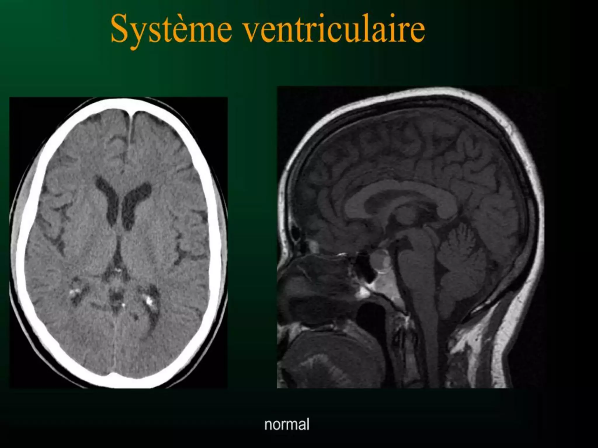 GUIDE D'INTERPRETATION D'UN TDM CEREBRALE EN URGENCE.pdf
