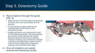 GuidedSMILE NobelBiocare Surgical Protocols | PPTX