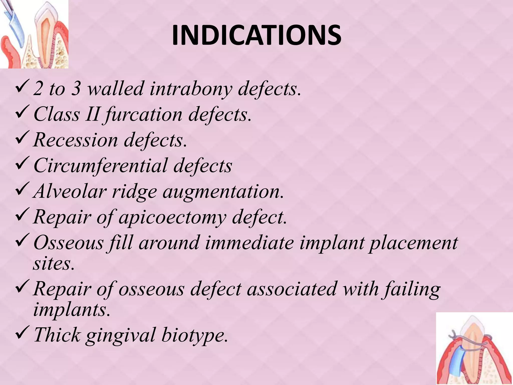 "GUIDED TISSUE REGENERATION" | PPTX