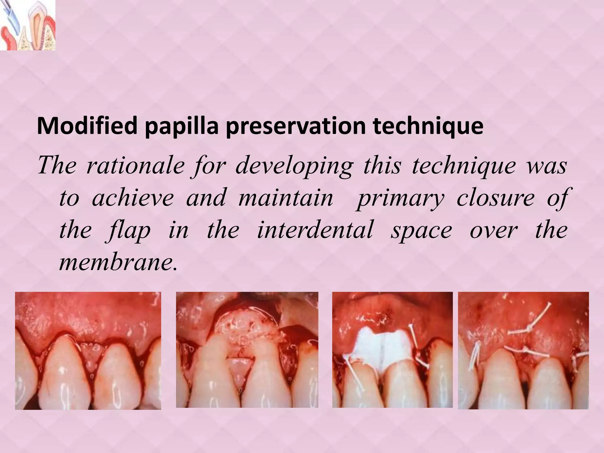 "GUIDED TISSUE REGENERATION" | PPTX