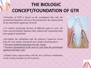 "GUIDED TISSUE REGENERATION" | PPTX