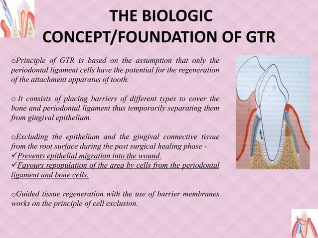 "GUIDED TISSUE REGENERATION" | PPTX | Dental Health | Diseases and Conditions
