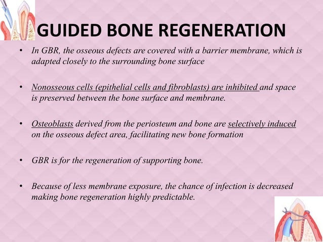 "GUIDED TISSUE REGENERATION" | PPTX | Dental Health | Diseases and Conditions