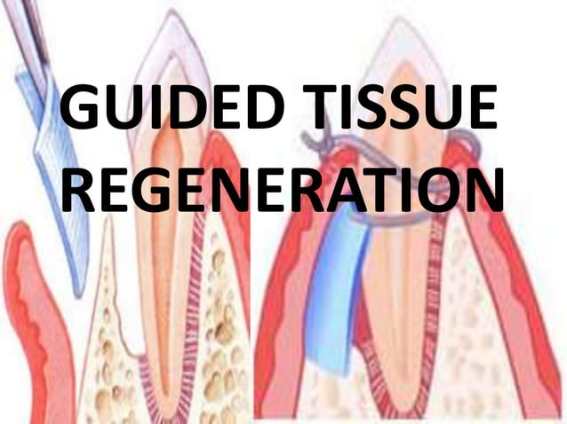 "GUIDED TISSUE REGENERATION"