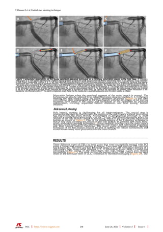 Guide extension assisted stenting technique for coronary bifurcation | PDF