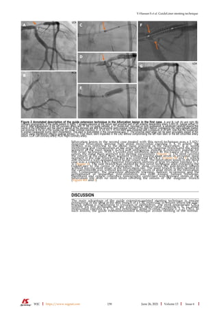 Guide extension assisted stenting technique for coronary bifurcation | PDF