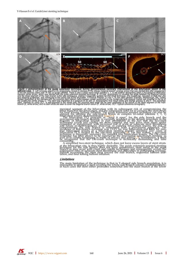 Guide extension assisted stenting technique for coronary bifurcation | PDF
