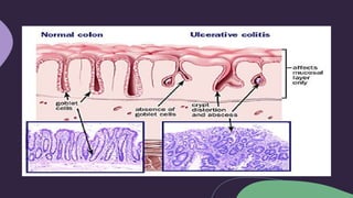 Guideline ppt on Ulcerative colitis | PPTX