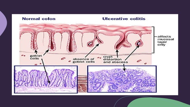 Guideline ppt on Ulcerative colitis | PPTX | Digestive Disorders ...
