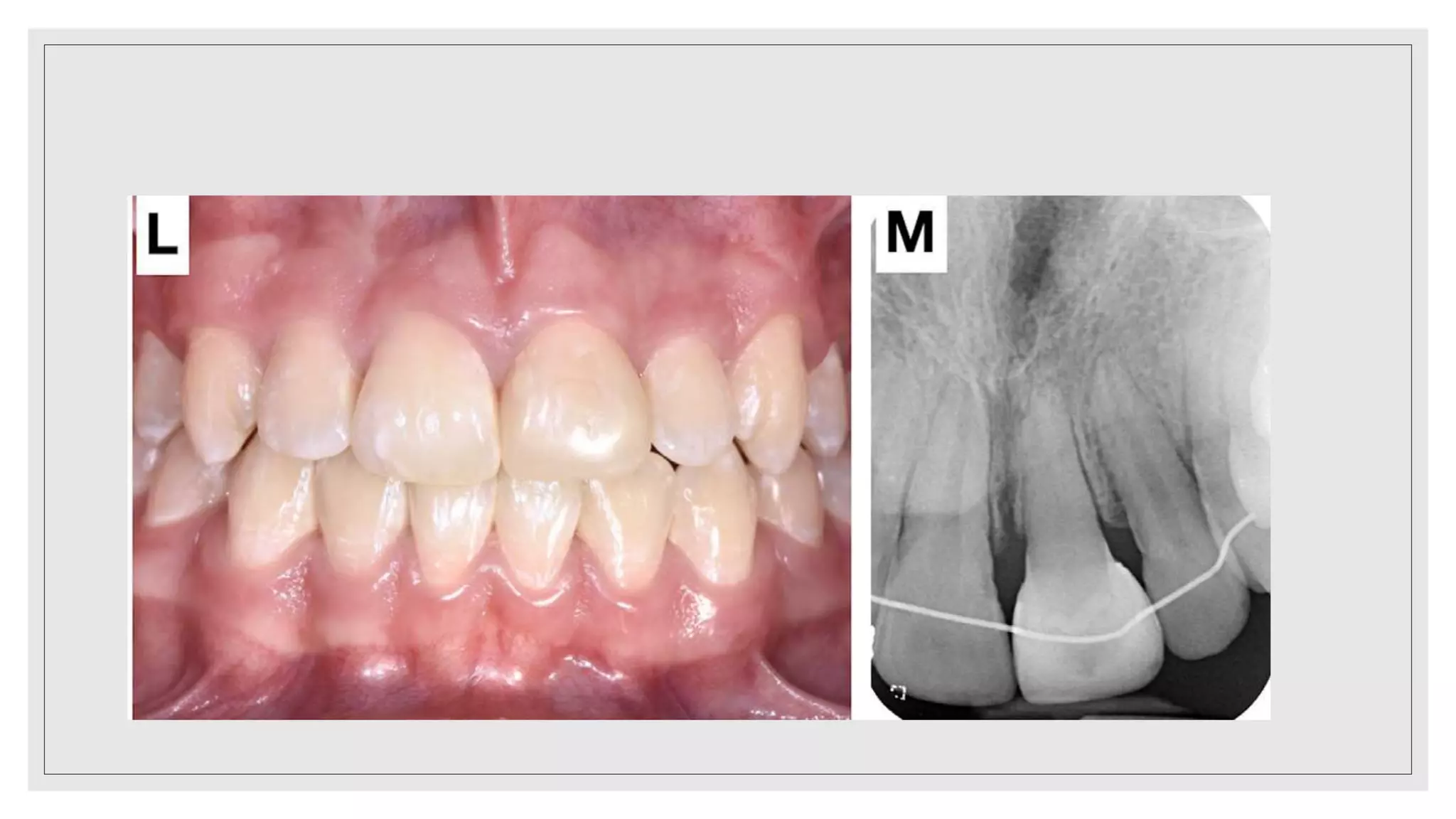 Guidelines for Dental autotransplantation. | PPTX