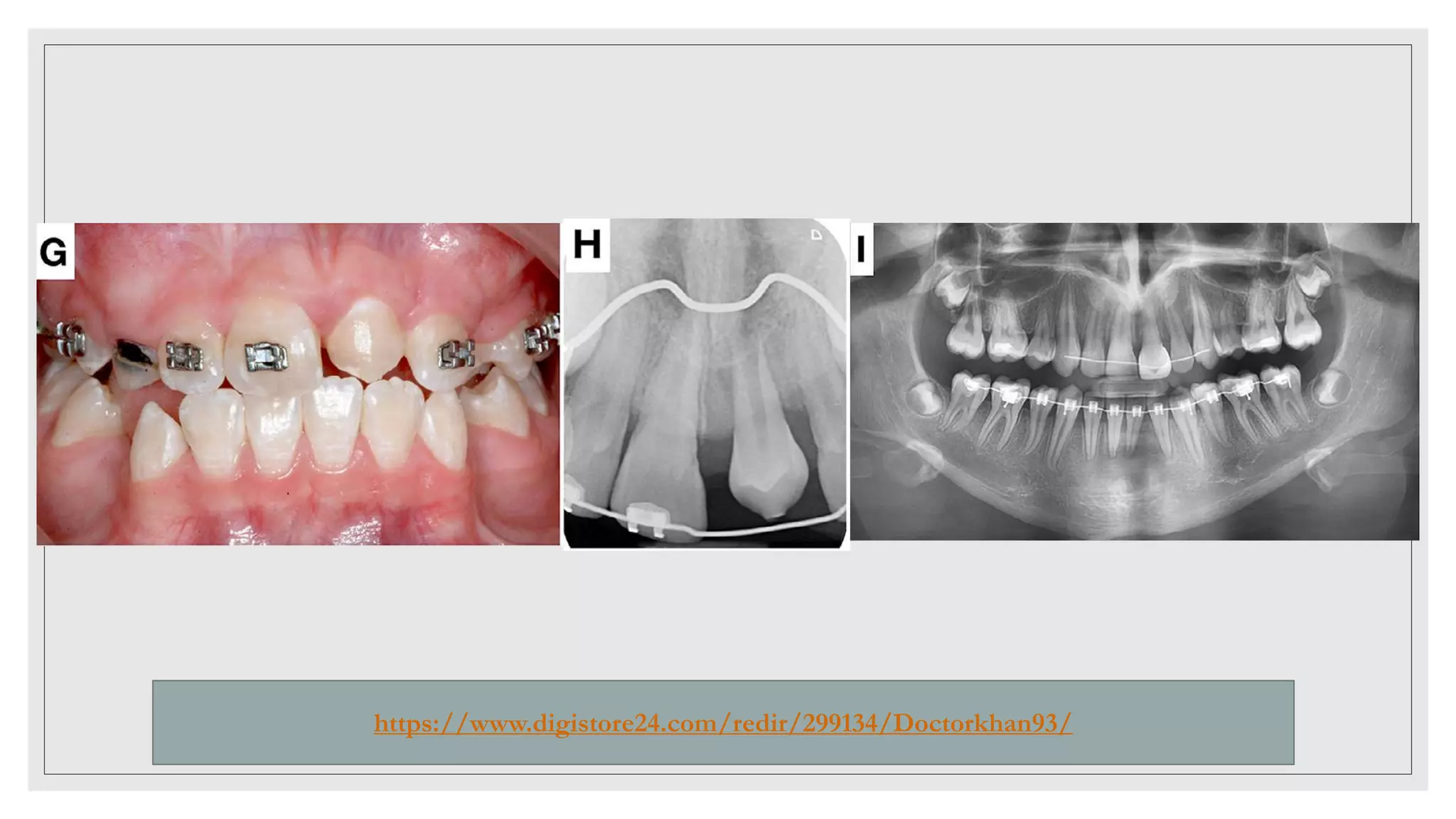 Guidelines for Dental autotransplantation. | PPTX