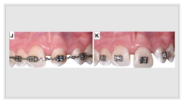 Guidelines for Dental autotransplantation. | PPTX