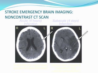 Guidelines for management of acute stroke | PPTX