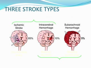 Guidelines for management of acute stroke | PPTX