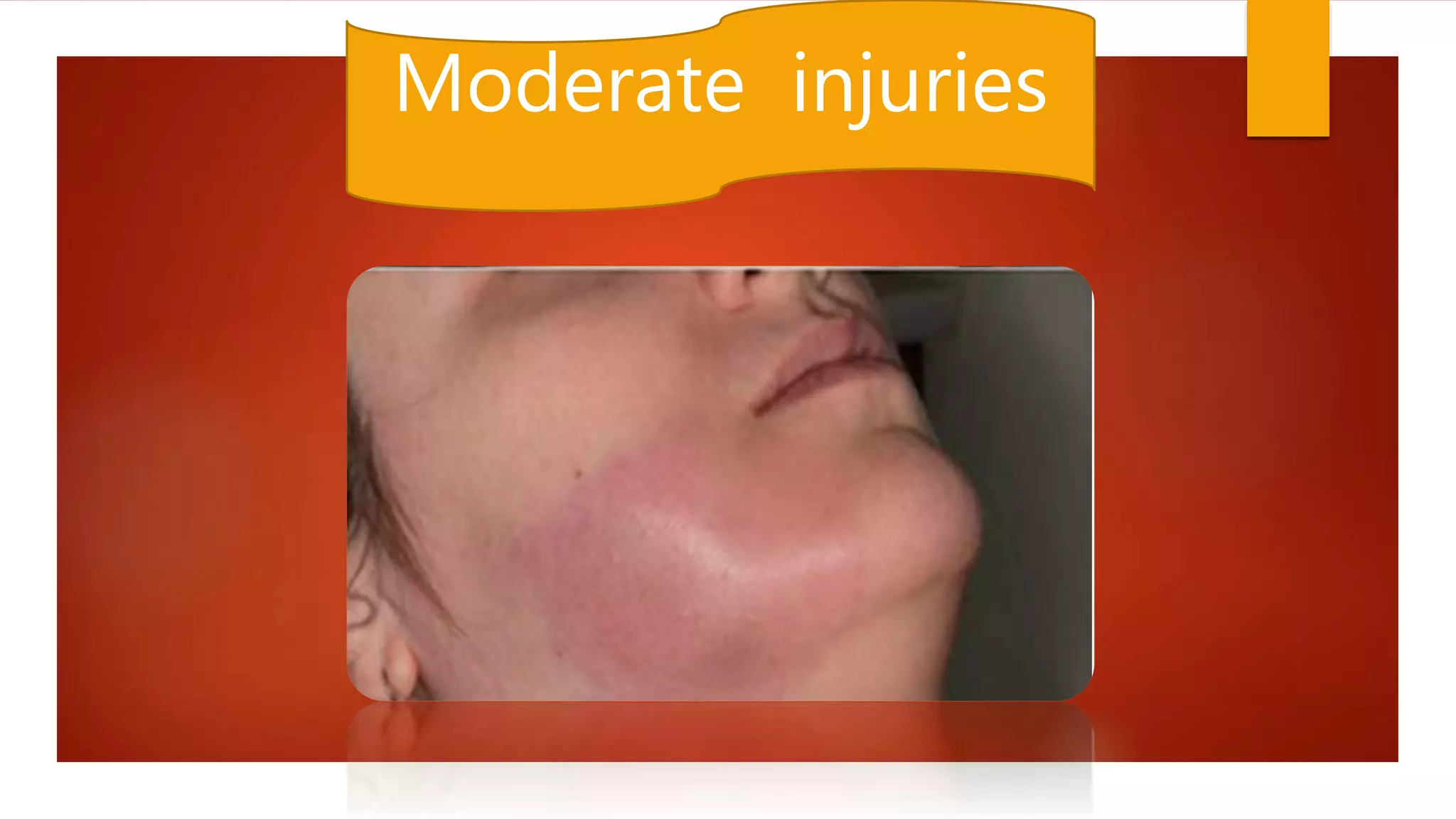 Guidelines for management of sodium hypochlorite extrusion injuries | PPTX