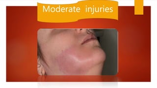 Guidelines for management of sodium hypochlorite extrusion injuries | PPTX