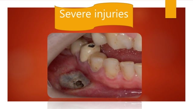 Guidelines for management of sodium hypochlorite extrusion injuries | PPT