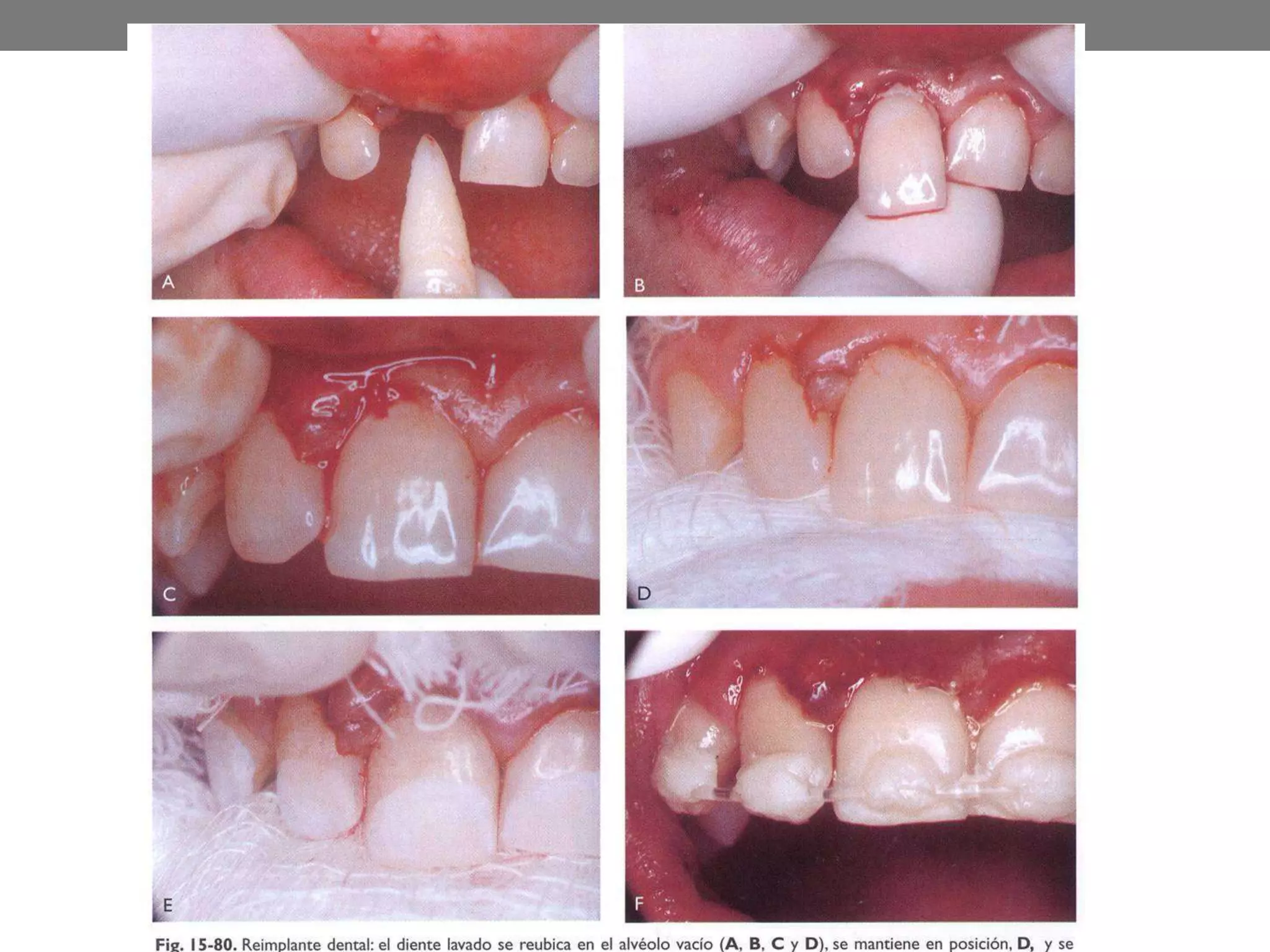Guidelines for the management of avulsion | PPTX